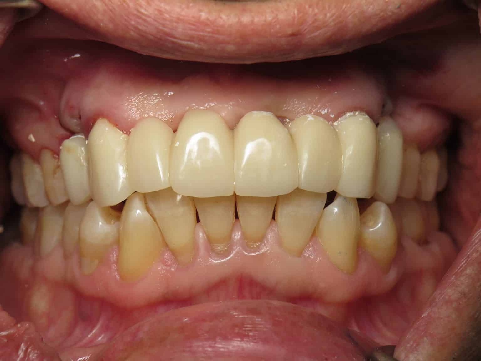 Flipper/Stayplate/Bridge Temporary Implant Bone Graft Facts