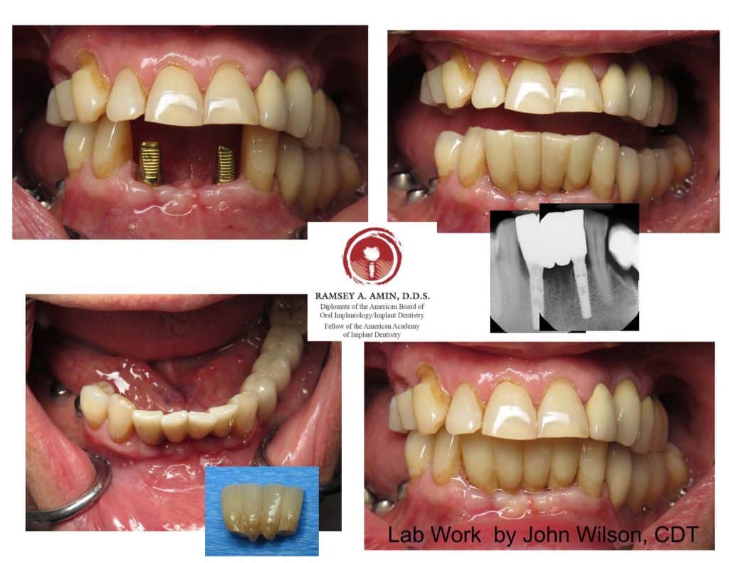 Lower Front Dental Implants With Gum Graft and Immediate Temporaries