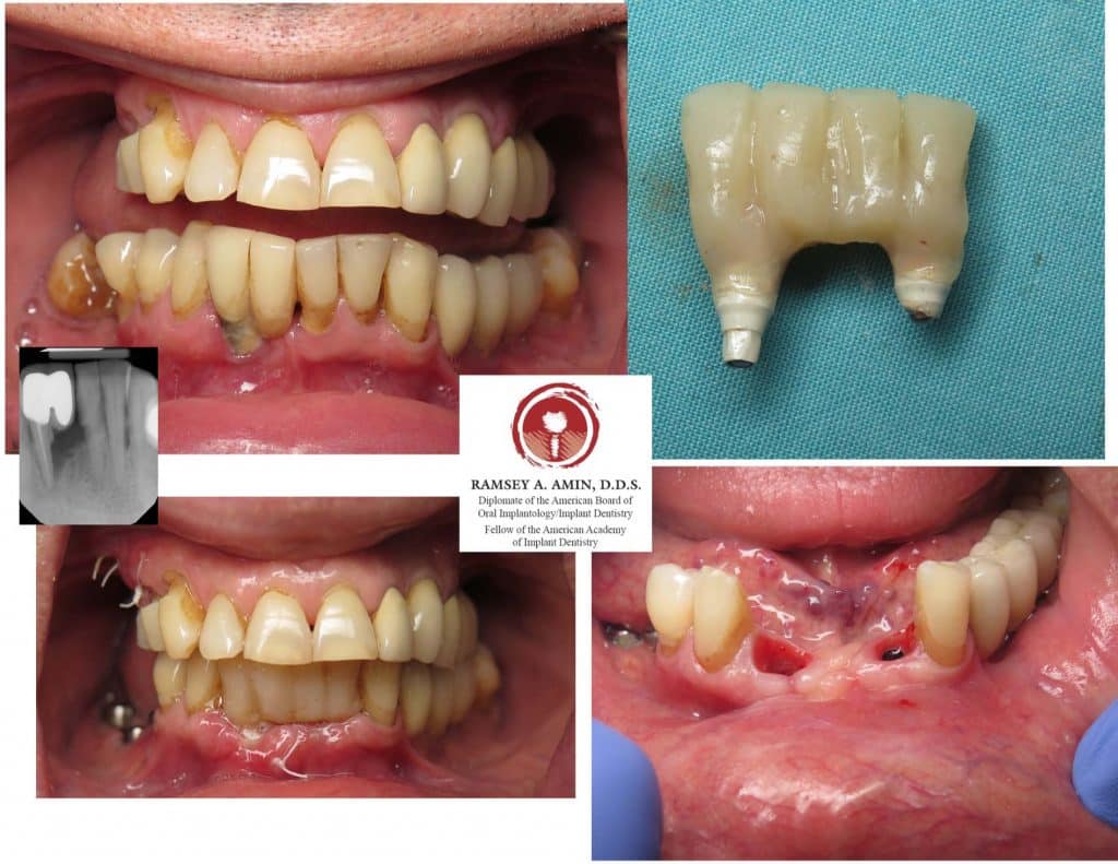 Lower Front Dental Implants With Gum Graft and Immediate Temporaries