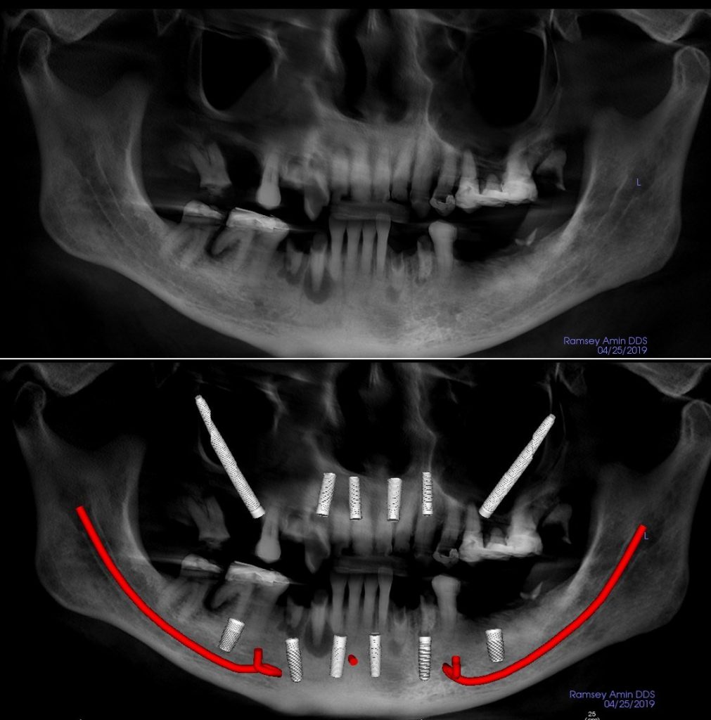 Dental Implant AP Spread for Upper "All on 4/X" Teeth
