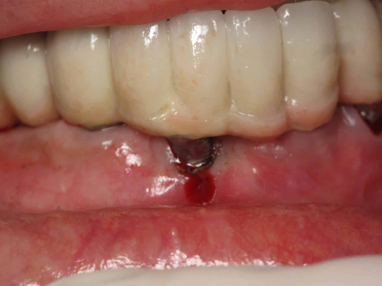 All-On-4 Dental Implant Problems And Complications