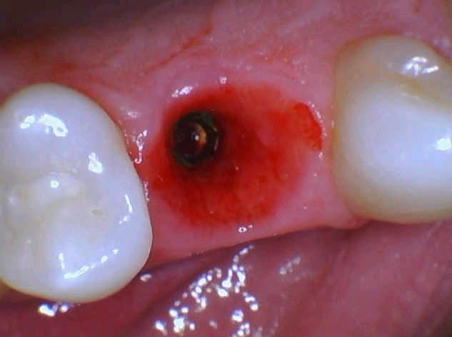 Immediate Premolar Dental Implant