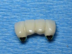 Immediate Implant Bridge Lower Jaw Front Teeth