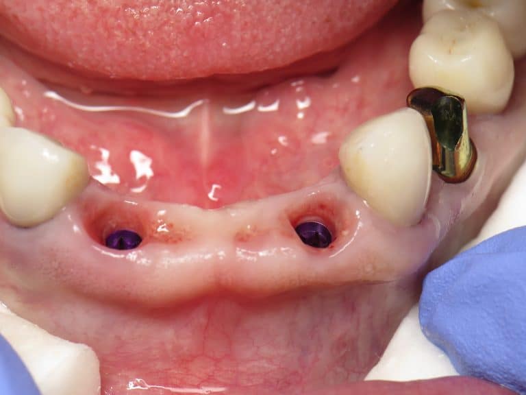 Immediate Implant Bridge Lower Jaw Front Teeth