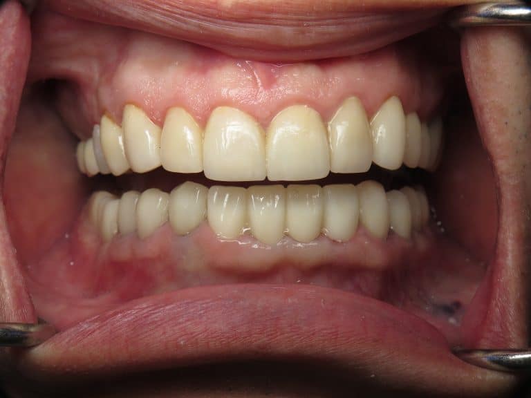 Immediate Implant Bridge Lower Jaw Front Teeth