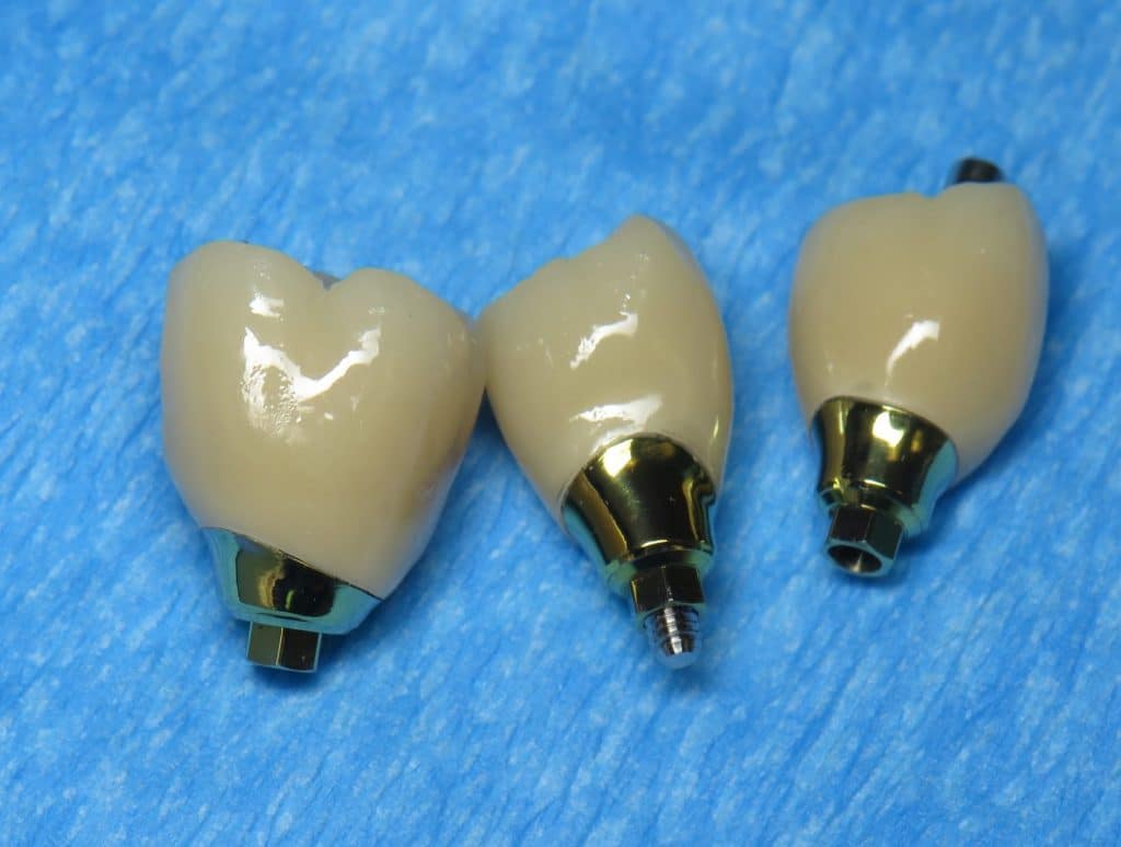 Slow and Staged Dental Implants