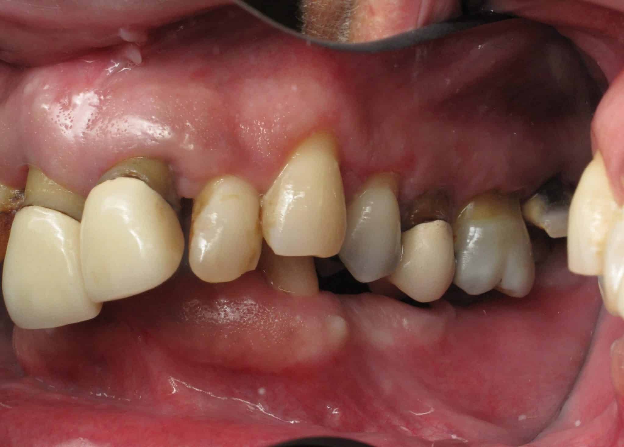 No Room, Too Tight for Implants