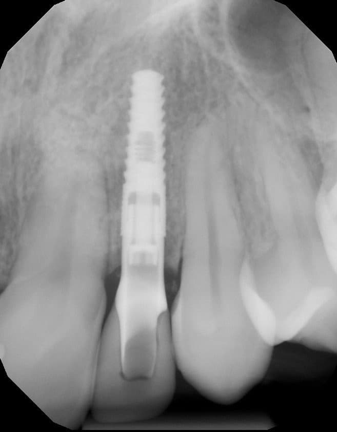 No Room, Too Tight for Implants