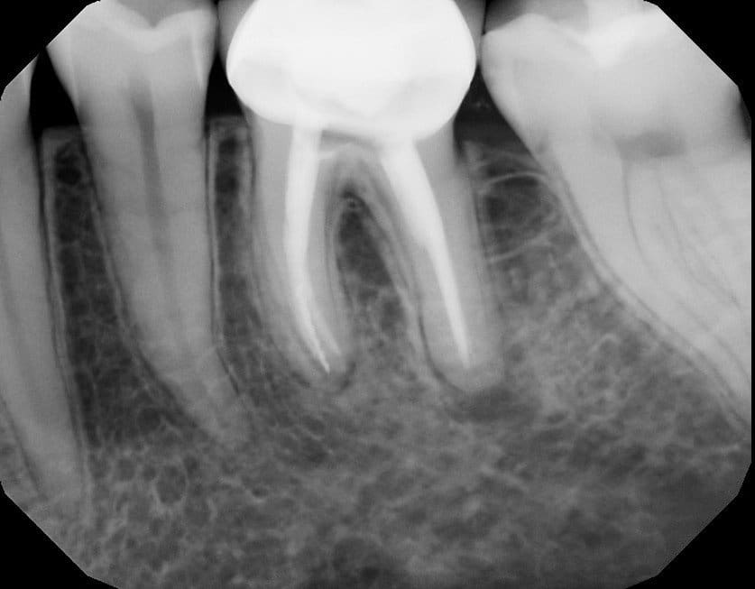 Infected Root Canals Molar Implants Infected Root Canals Molar Implants