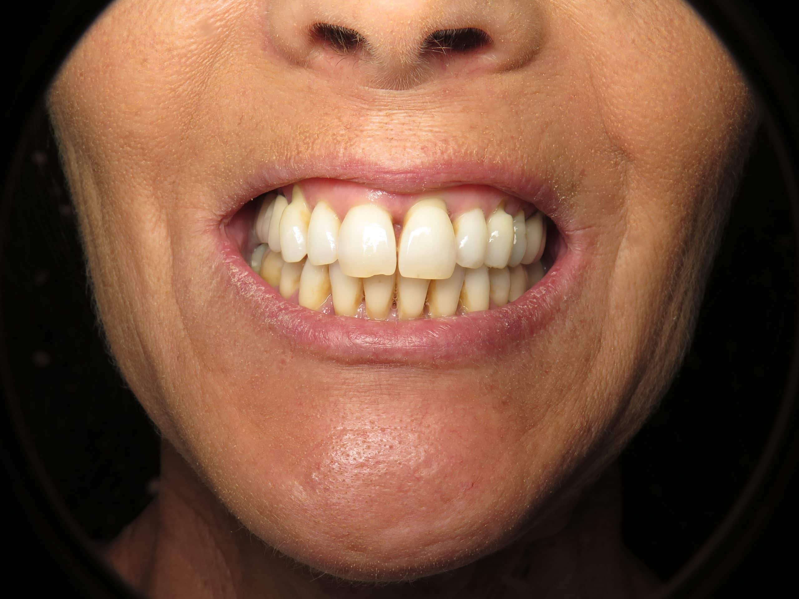 The All on 4 Dental Implants Process