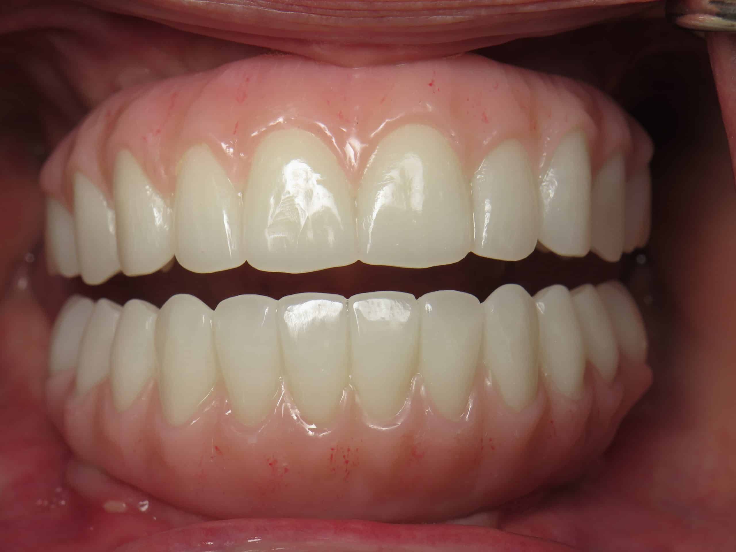 The All on 4 Dental Implants Process