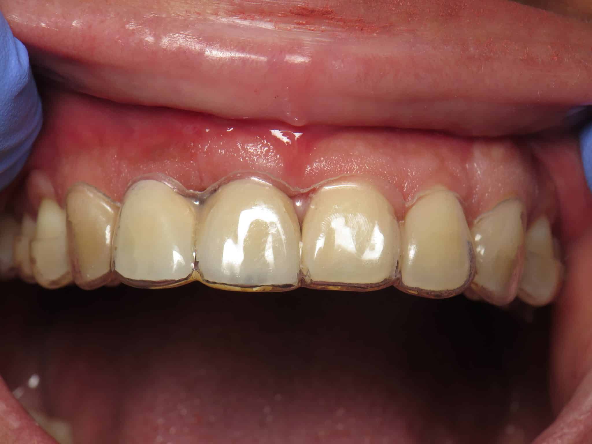 Dental Implants –Do I Have To Be Without Teeth While They Heal?