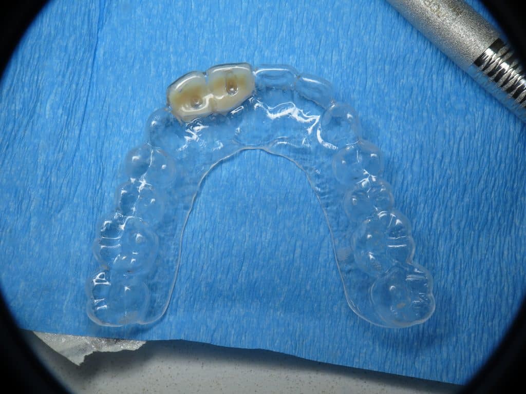 Dental Implants –Do I Have To Be Without Teeth While They Heal?