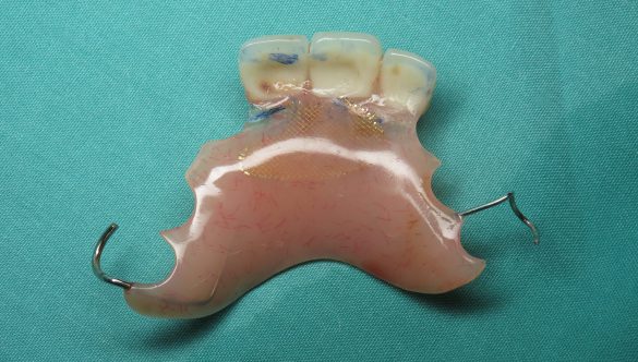 stayplate Archives | Ramsey Amin, DDS