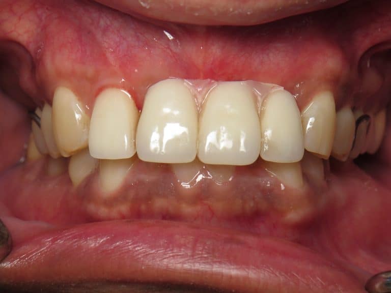 Dental Implants –Do I Have To Be Without Teeth While They Heal?