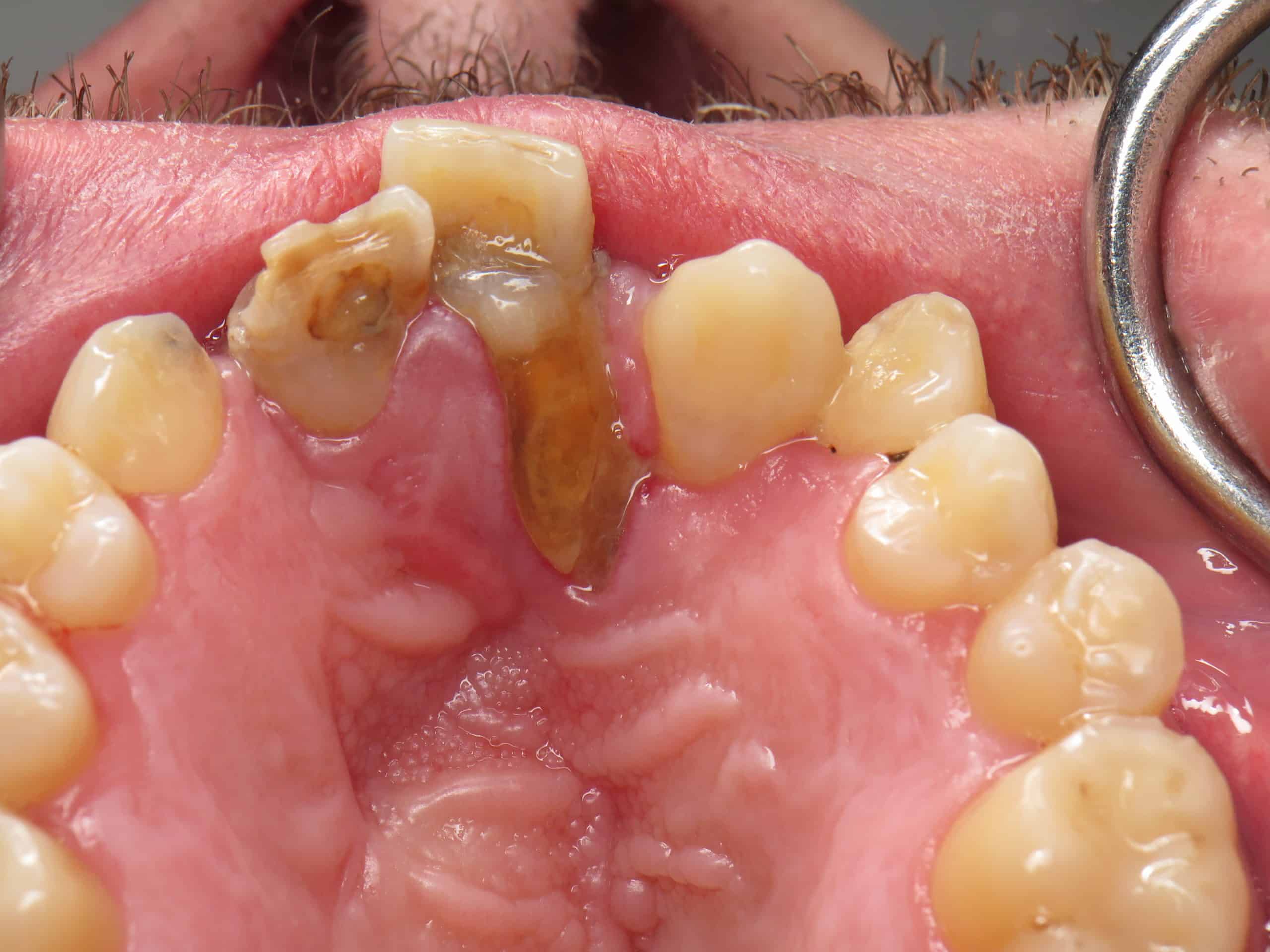 Dental Implants for Cleft Palate | Ramsey Amin DDS - Burbank, CA