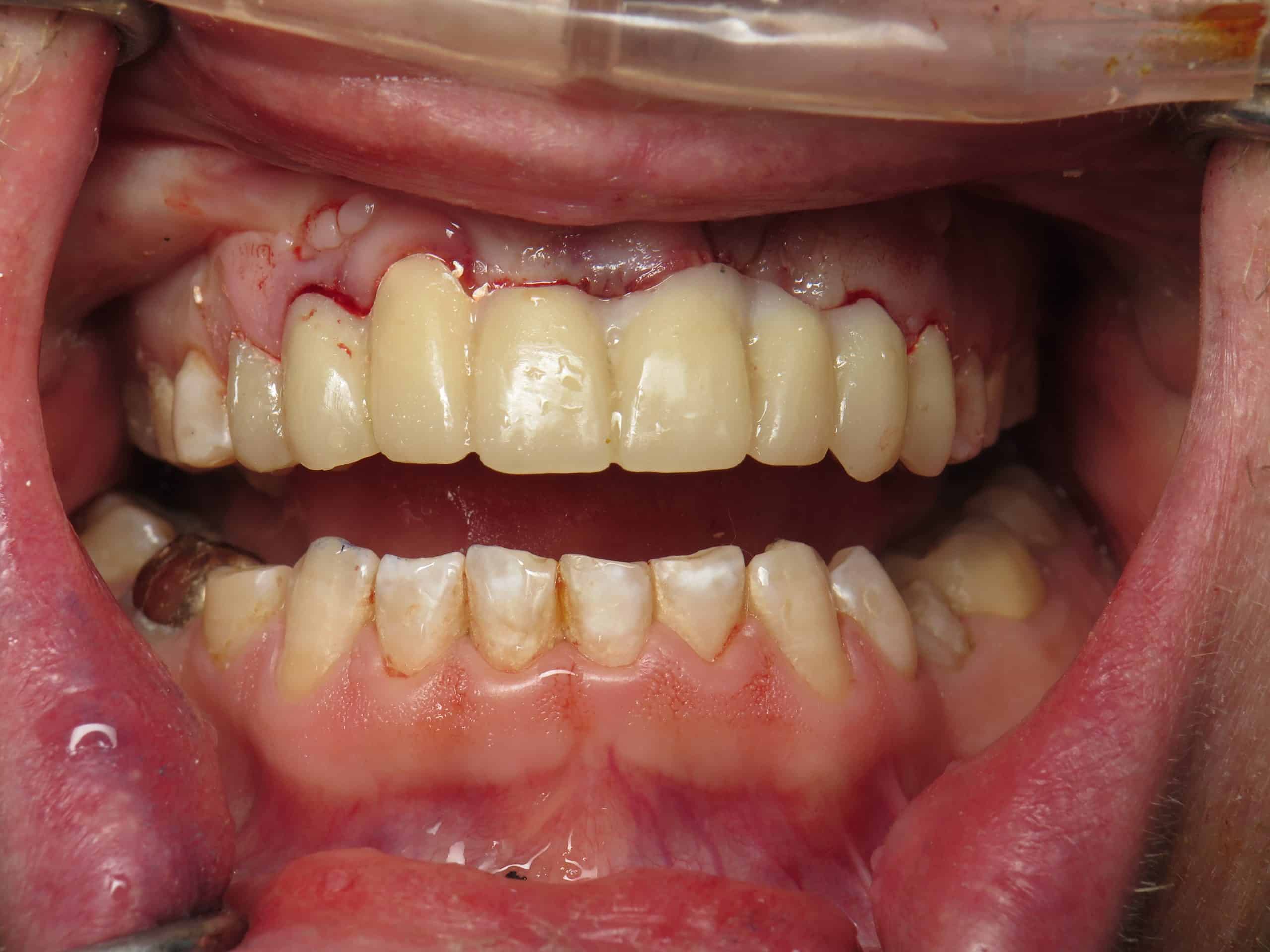 Dental Implants for Cleft Palate | Ramsey Amin DDS - Burbank, CA