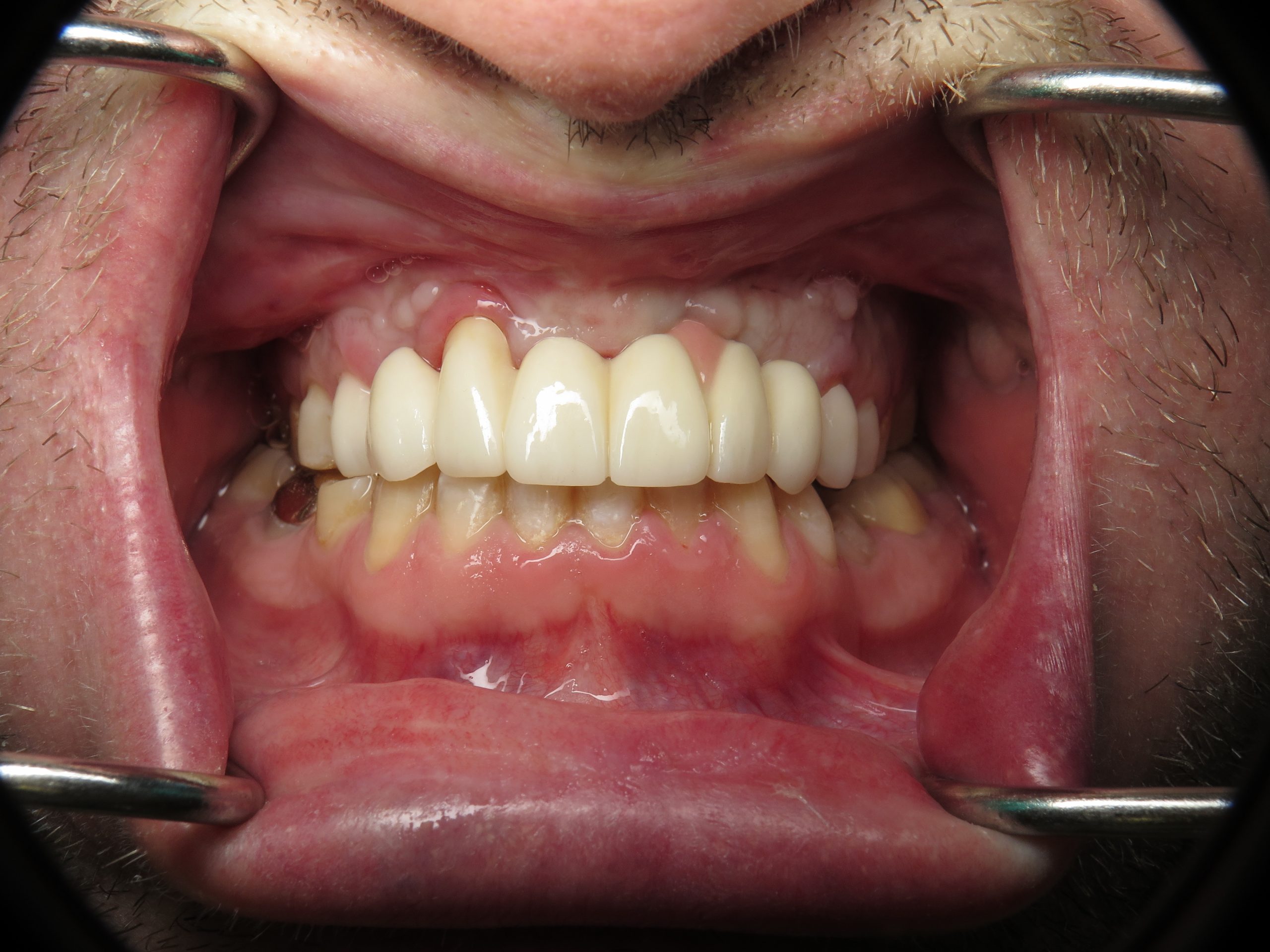 Dental Implants for Cleft Palate | Ramsey Amin DDS - Burbank, CA