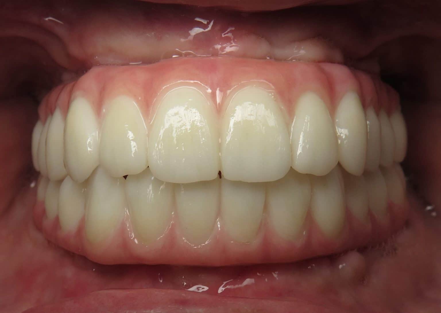The Ovate Pontic – Ramsey Amin DDS of Burbank Explains This Dental ... The Ovate Pontic – Ramsey Amin DDS of Burbank Explains This Dental ...