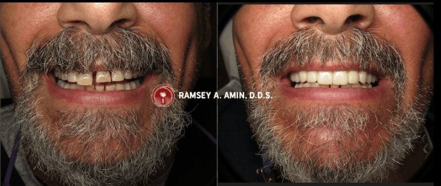Botox® For Teeth Grinding Jaw Clenching And Dental Implants