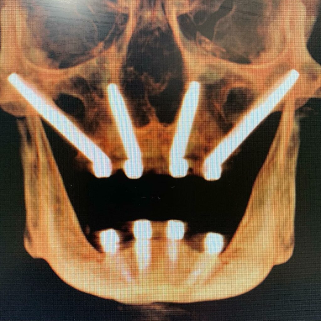 Dental Implant Overdenture Locator Attachments...Patient Information