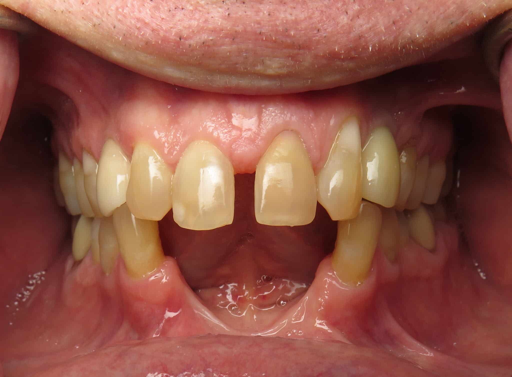 The Ovate Pontic – Ramsey Amin DDS of Burbank Explains This Dental ... The Ovate Pontic – Ramsey Amin DDS of Burbank Explains This Dental ...