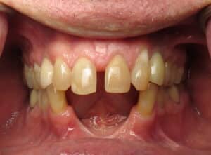 Bone Grafting or No Bone Grafting? - Ramsey A. Amin DDS