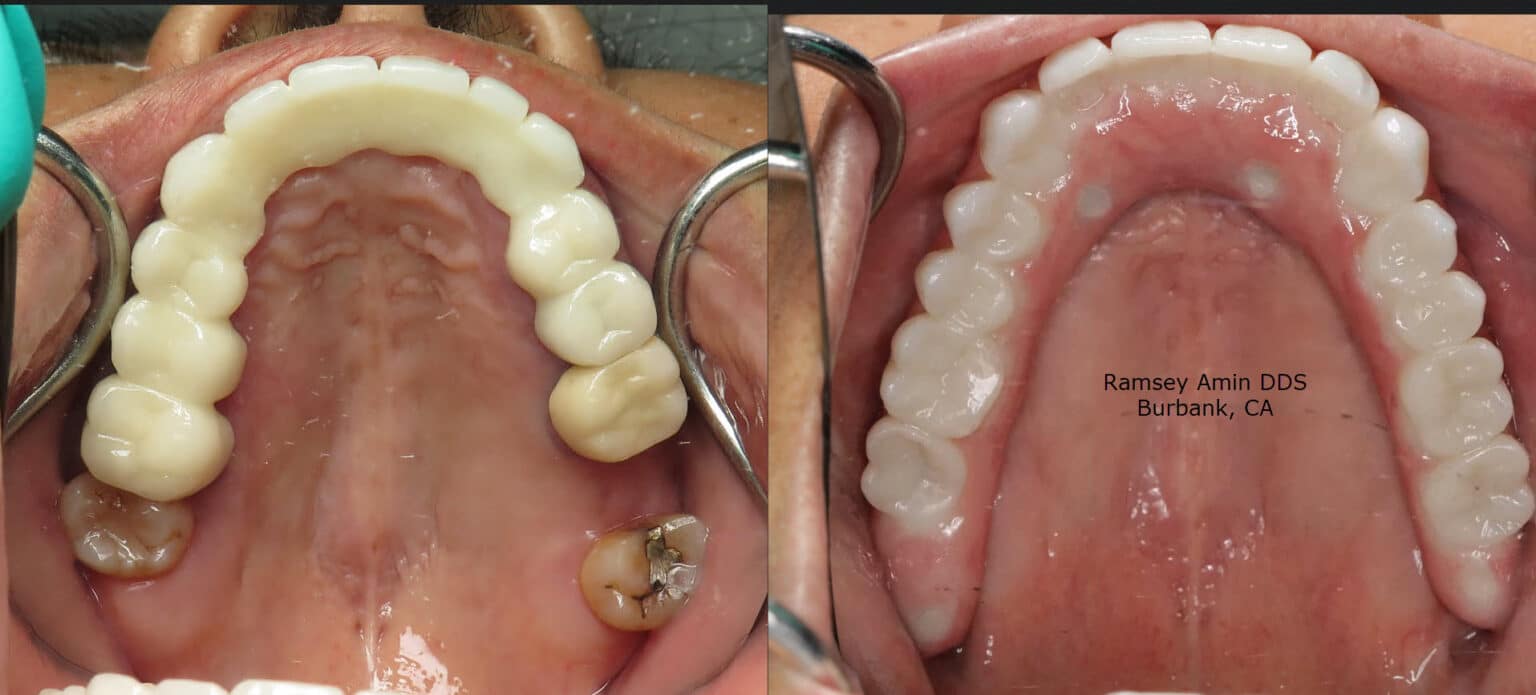The Ovate Pontic – Ramsey Amin DDS of Burbank Explains This Dental ...