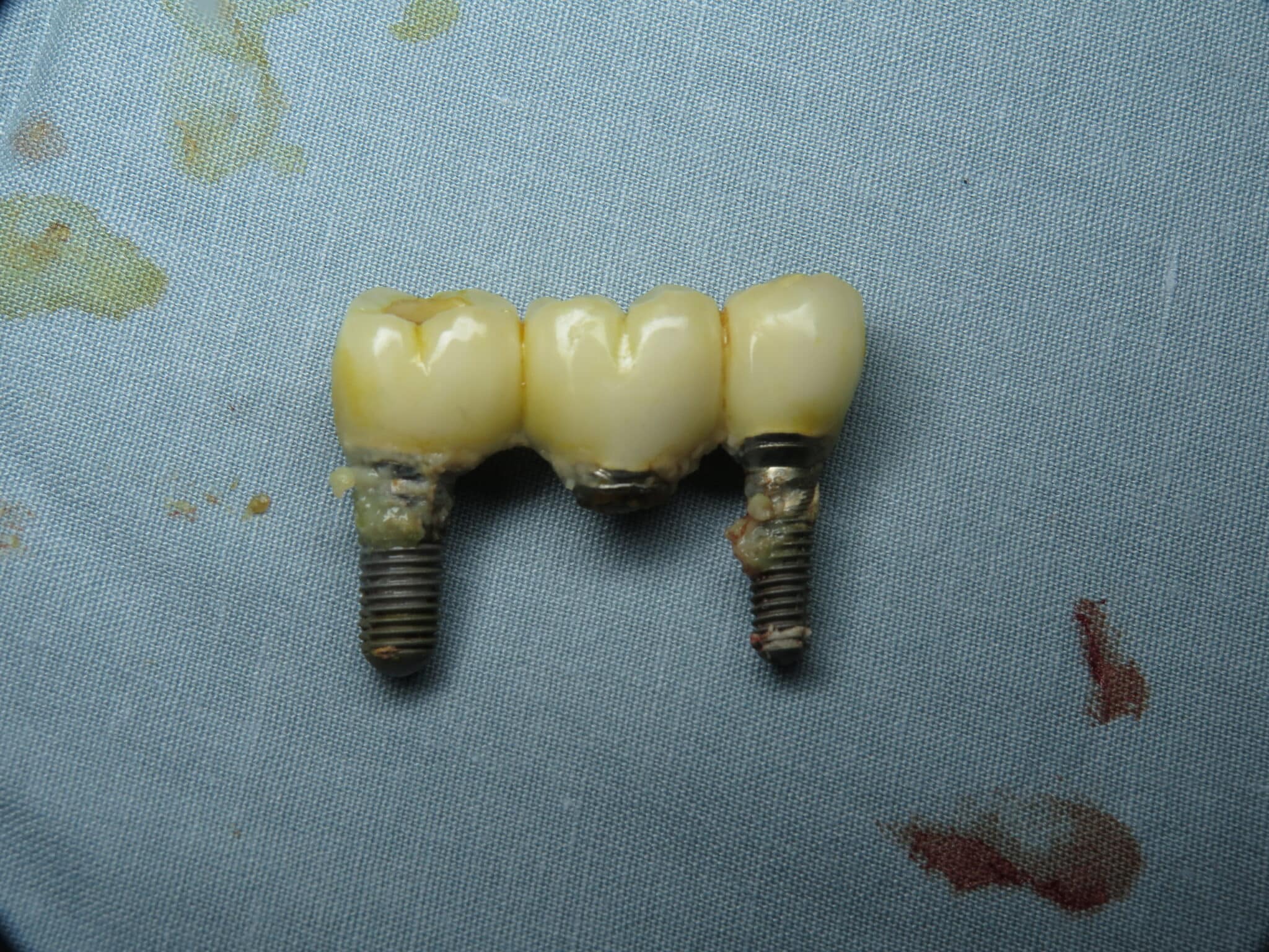 Dental Tourism - Do You Need Dental Implants?