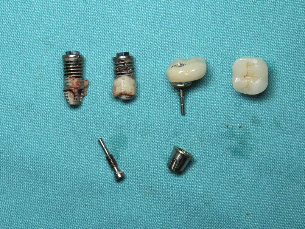 Dental Tourism - Do You Need Dental Implants?