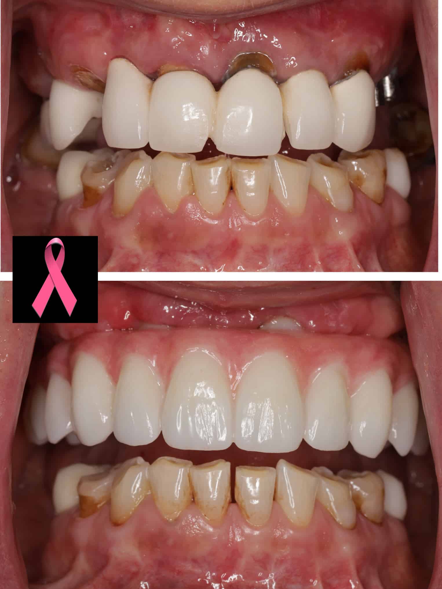 Chemotherapy and Dental Implants - What You Need to Know