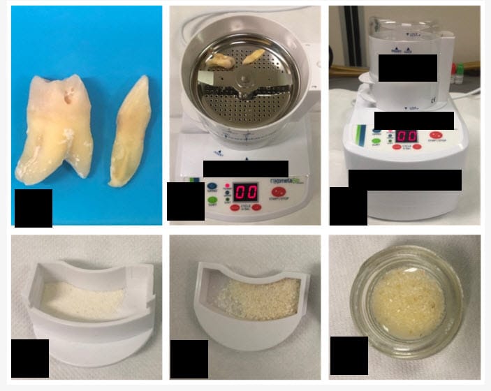 Dental Bone Graft Material: Using Your Own Teeth
