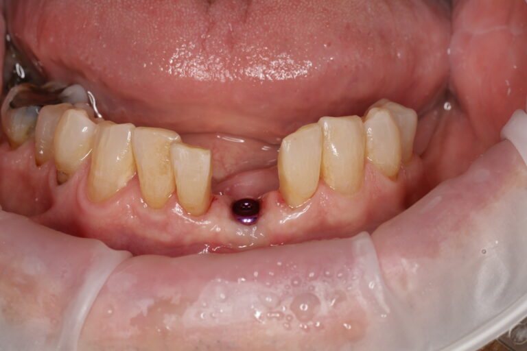 Flipper/Stayplate/Bridge Temporary Implant Bone Graft Facts