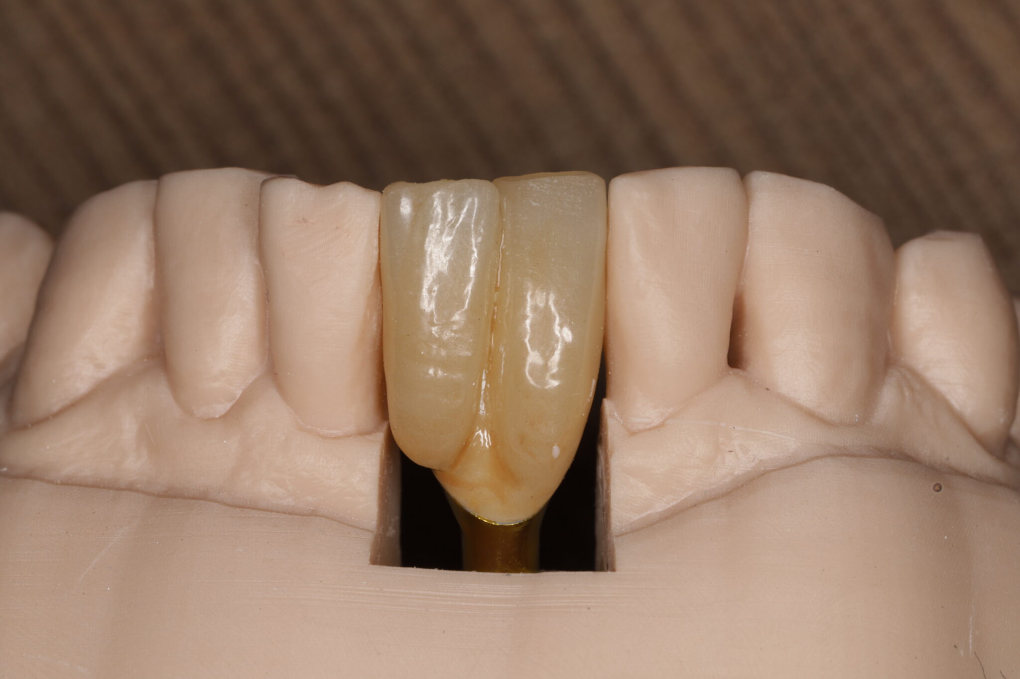 Purposely Crooked Double Implant for a Lower Front Tooth