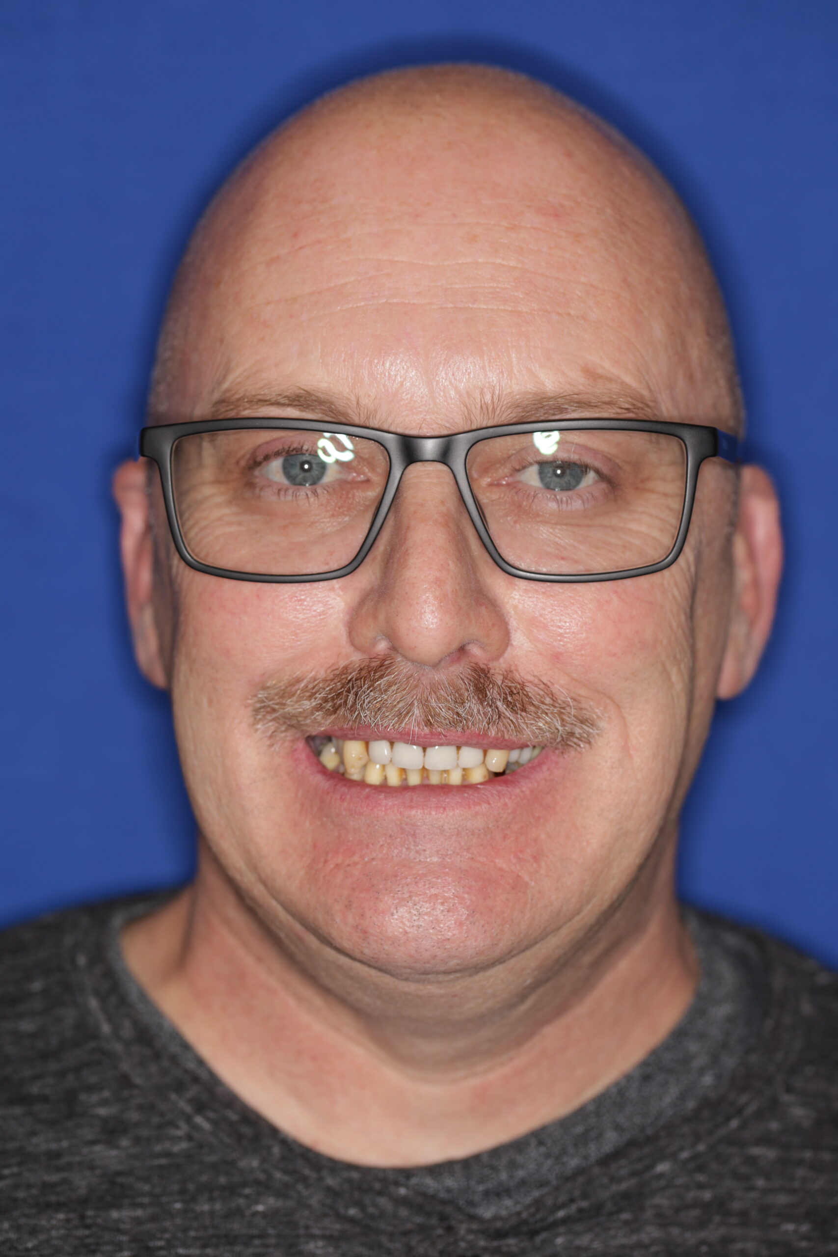 When All Teeth Need To Be Extracted For Full Mouth Implants