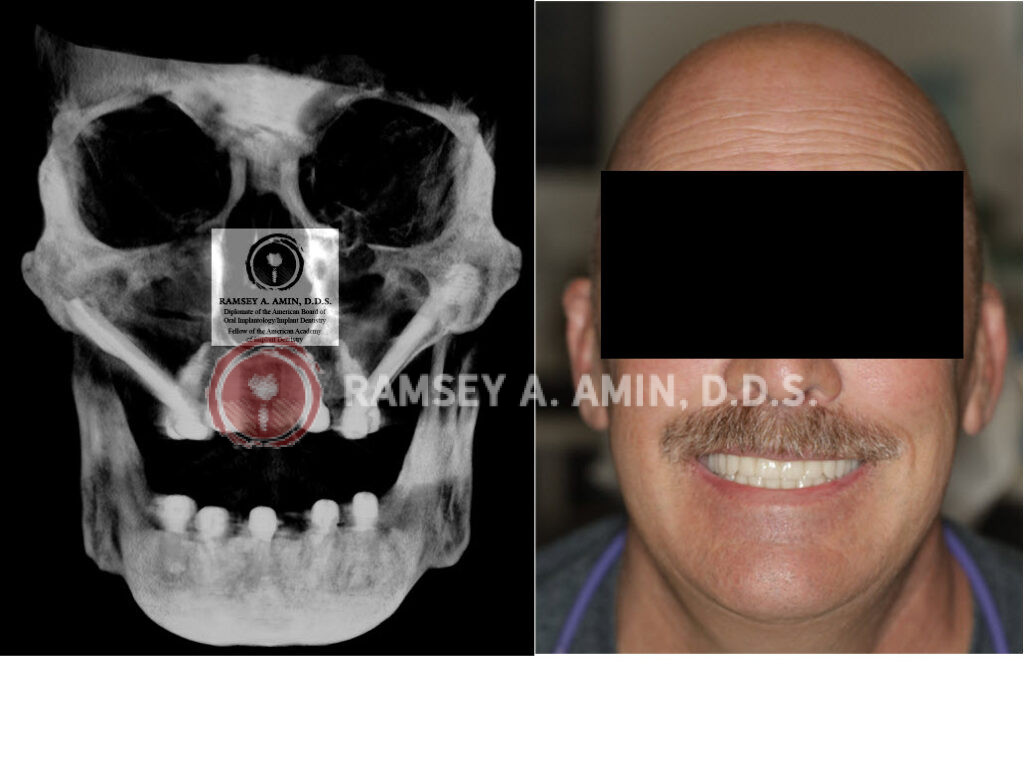The Ovate Pontic – Ramsey Amin DDS of Burbank Explains This Dental ...