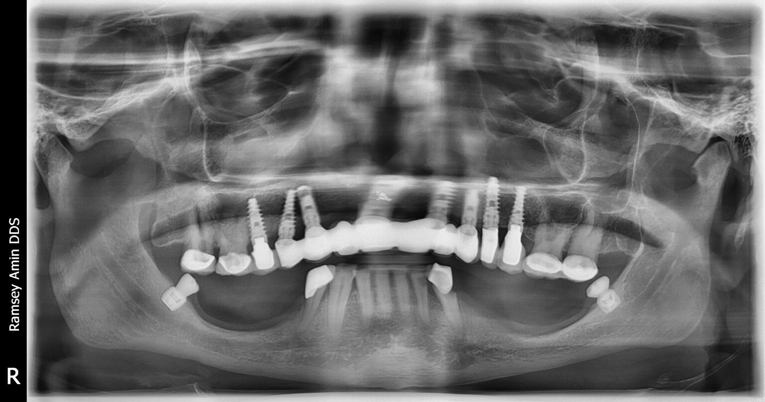 Bone Reduction Leveling For Dental Implants to Avoid a Bone Graft