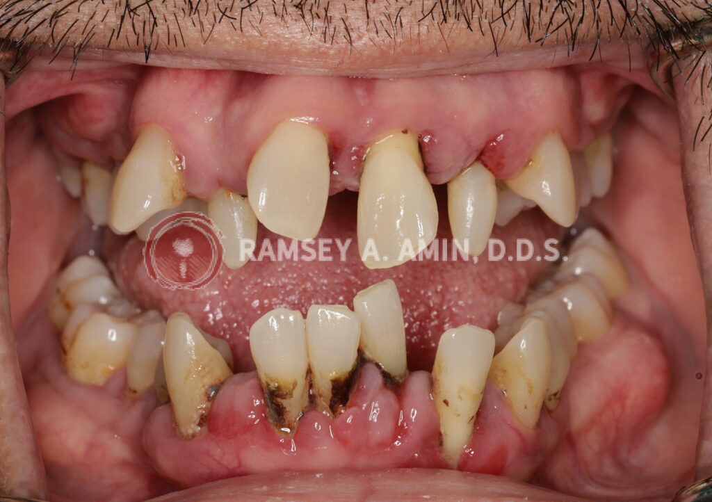 Flipper/Stayplate/Bridge Temporary Implant Bone Graft Facts