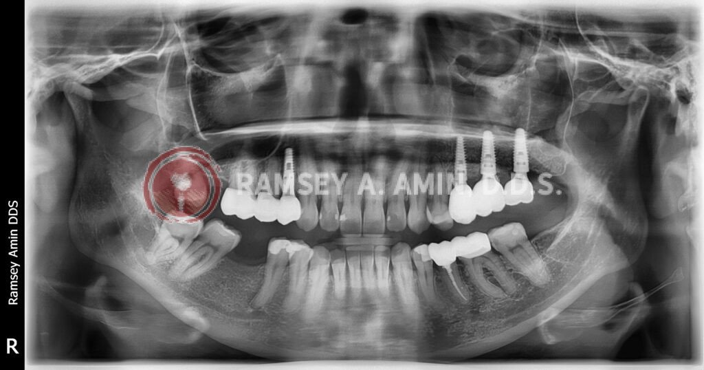 Why a Sinus Lift for Implants? - Dr. Ramsey Amin