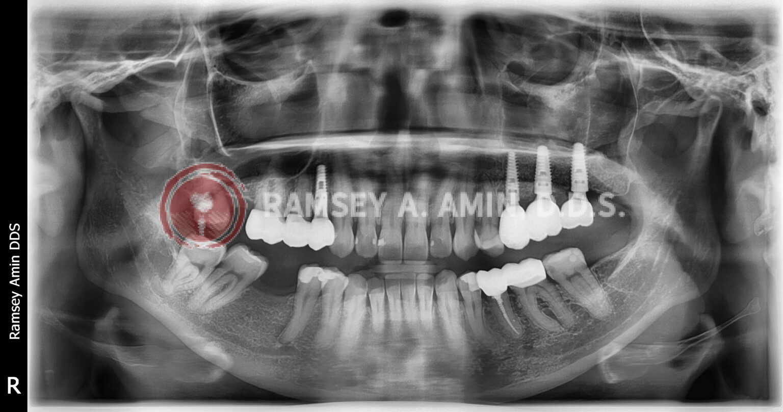 I Can’t Get Under My Full Implant Bridge To Clean