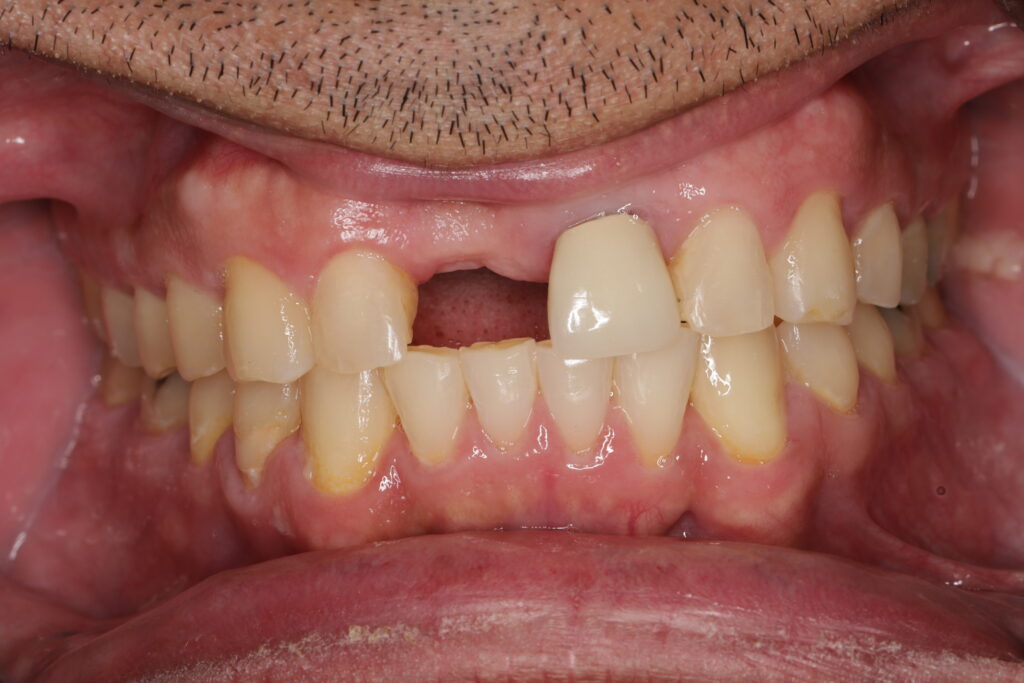 Dental Bone Graft Using Own Bone - Ramsey Amin, DDS