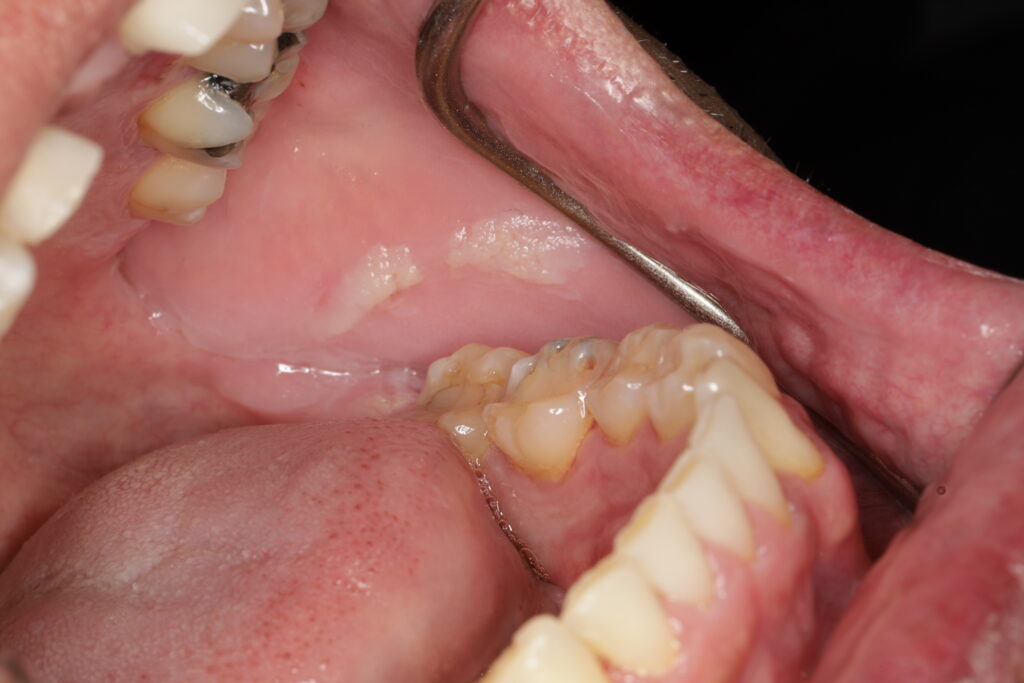 Dental Bone Graft Using Own Bone - Ramsey Amin, DDS