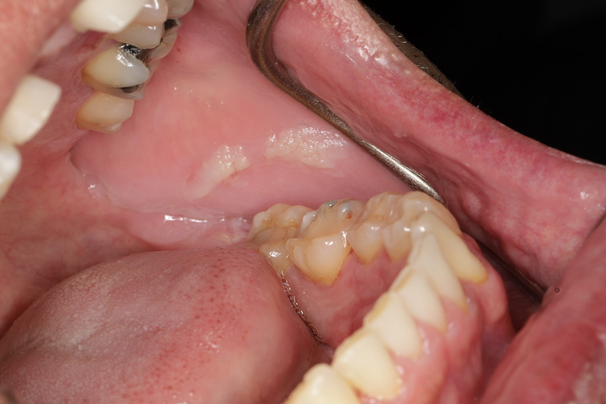 Dental Bone Graft Using Own Bone - Ramsey Amin, DDS