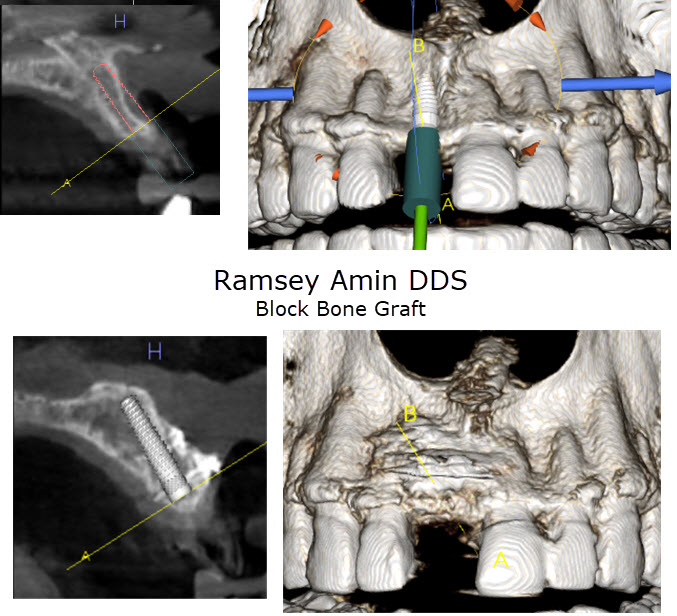 Dental Bone Graft Using Own Bone - Ramsey Amin, DDS