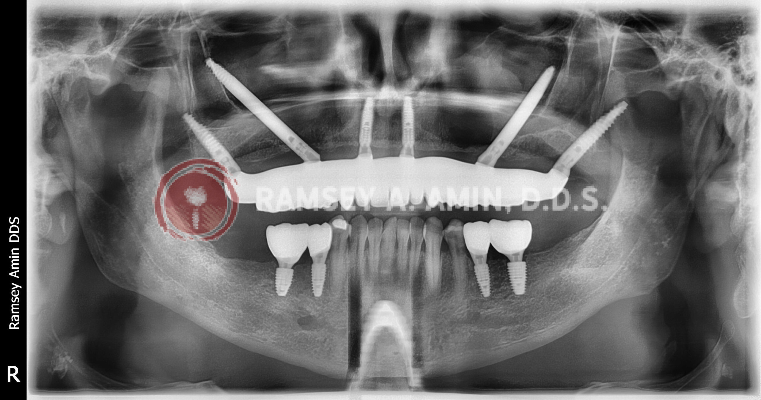 Not All Teeth Need to be Removed for Full Implants - Dr. Amin